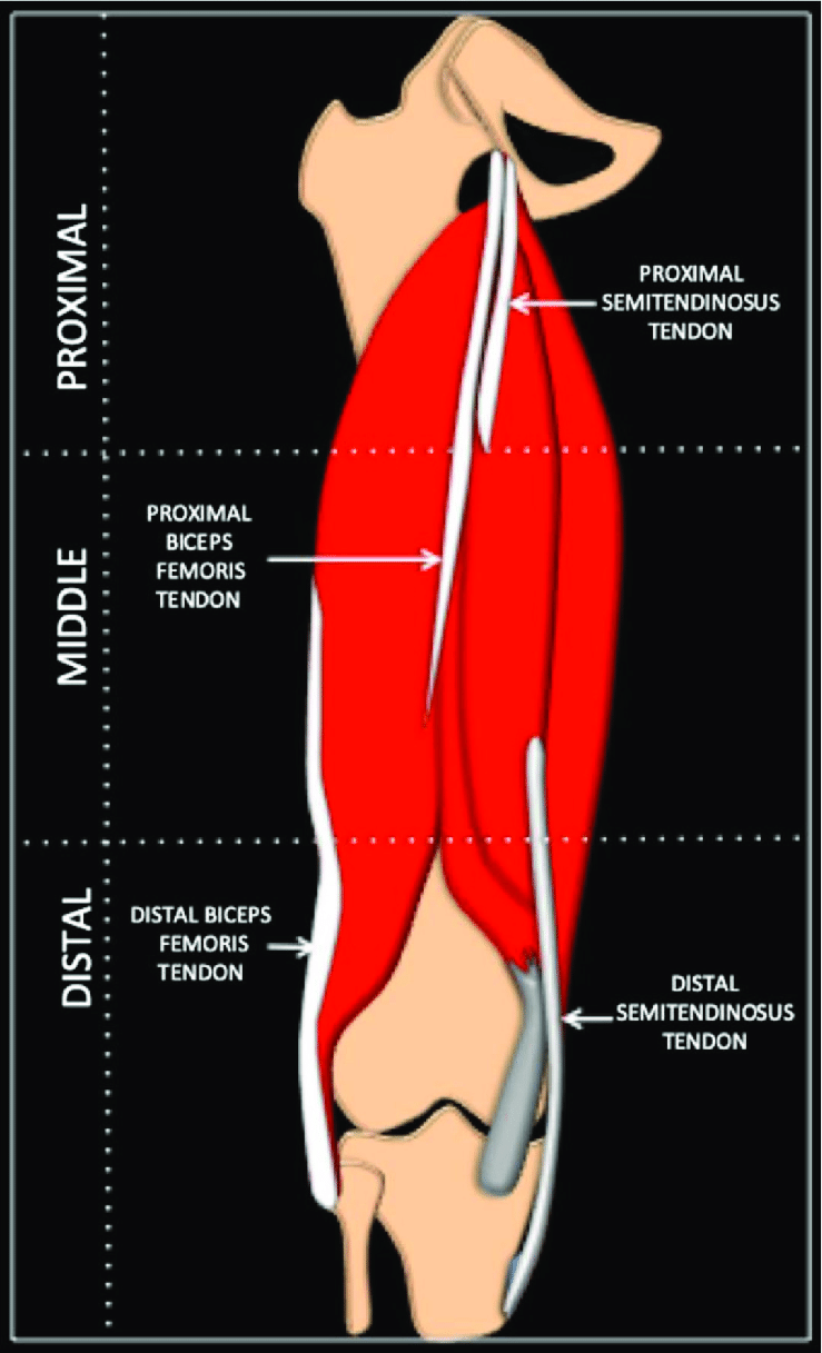 proximal hamstring tendinopathy in runners, how to fix it